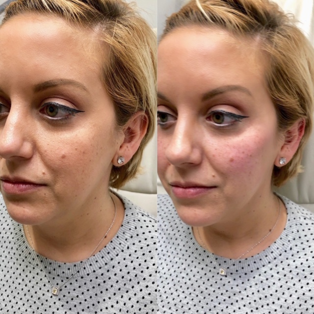 Dermal Fillers: Recovery + What to Expect – Tata to Cancer